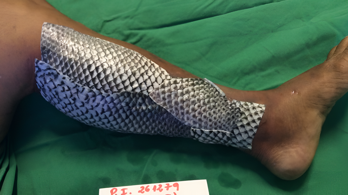 Tilapia Skin: The Unexpected Hero in Burn Recovery - Social Science